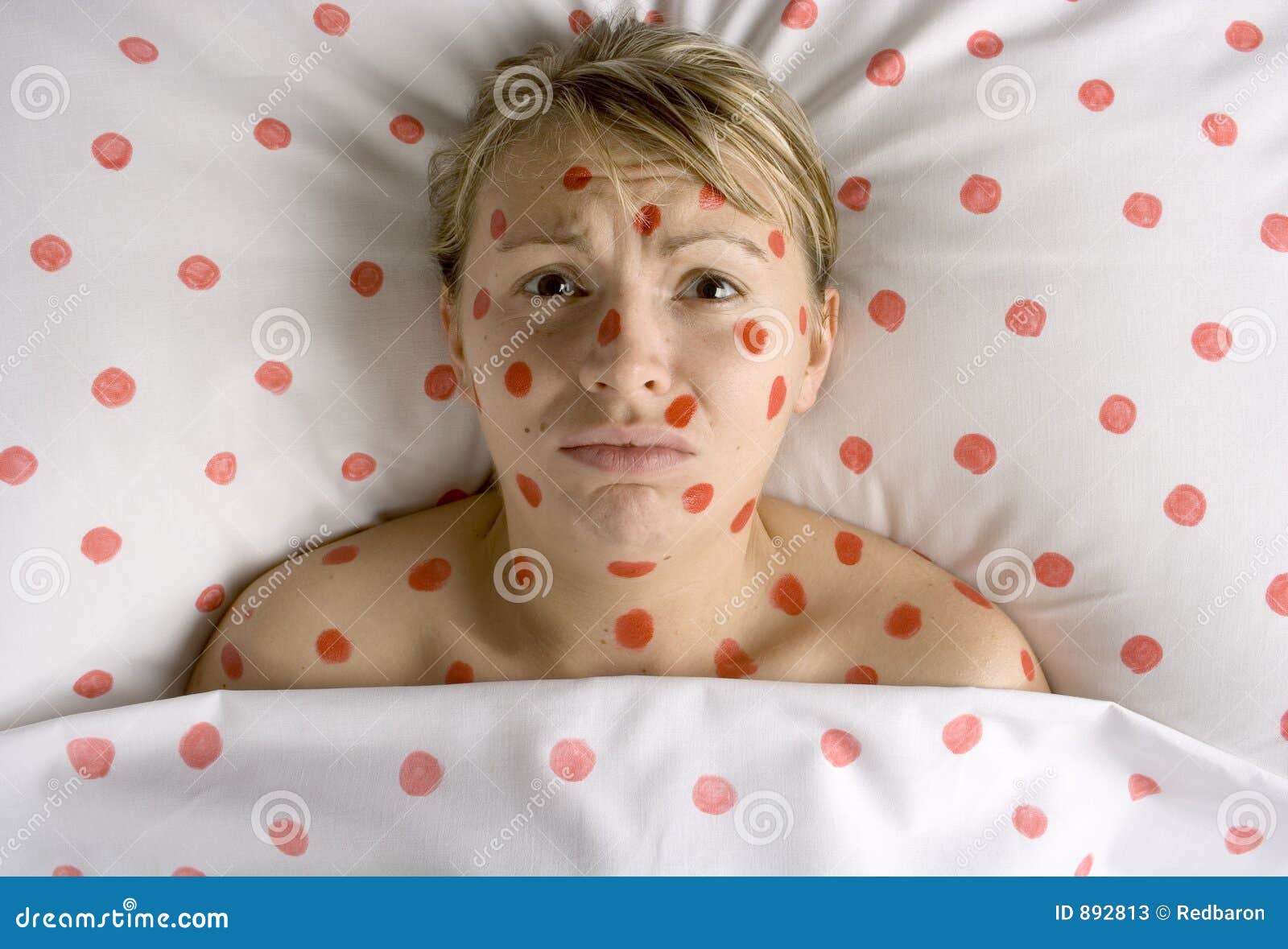 Woman with Red Spots on Face and Body Stock Image - Image of sickness ...