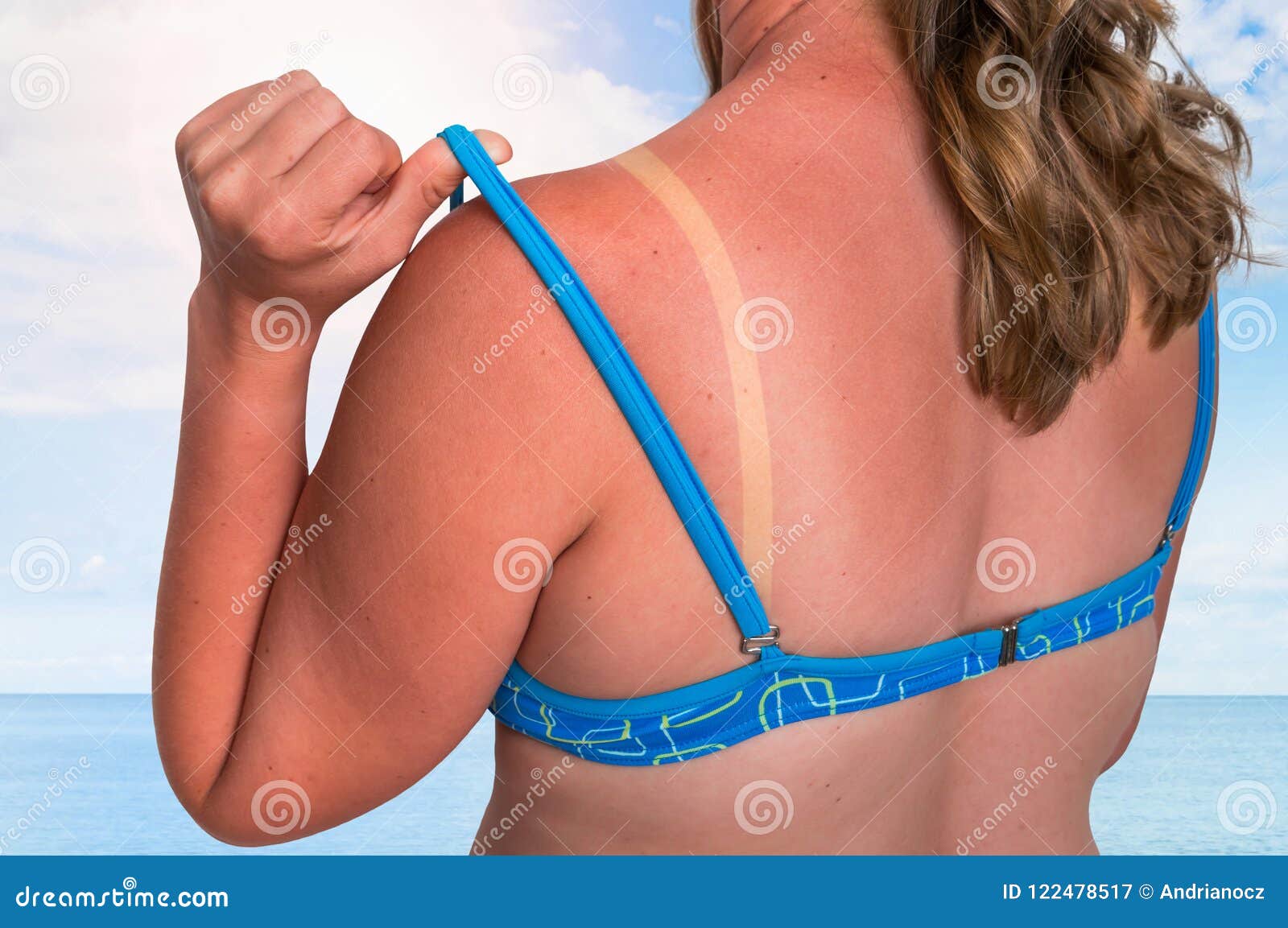 Sunburn Concept Young Woman With Red Sunburned Skin On Her Back