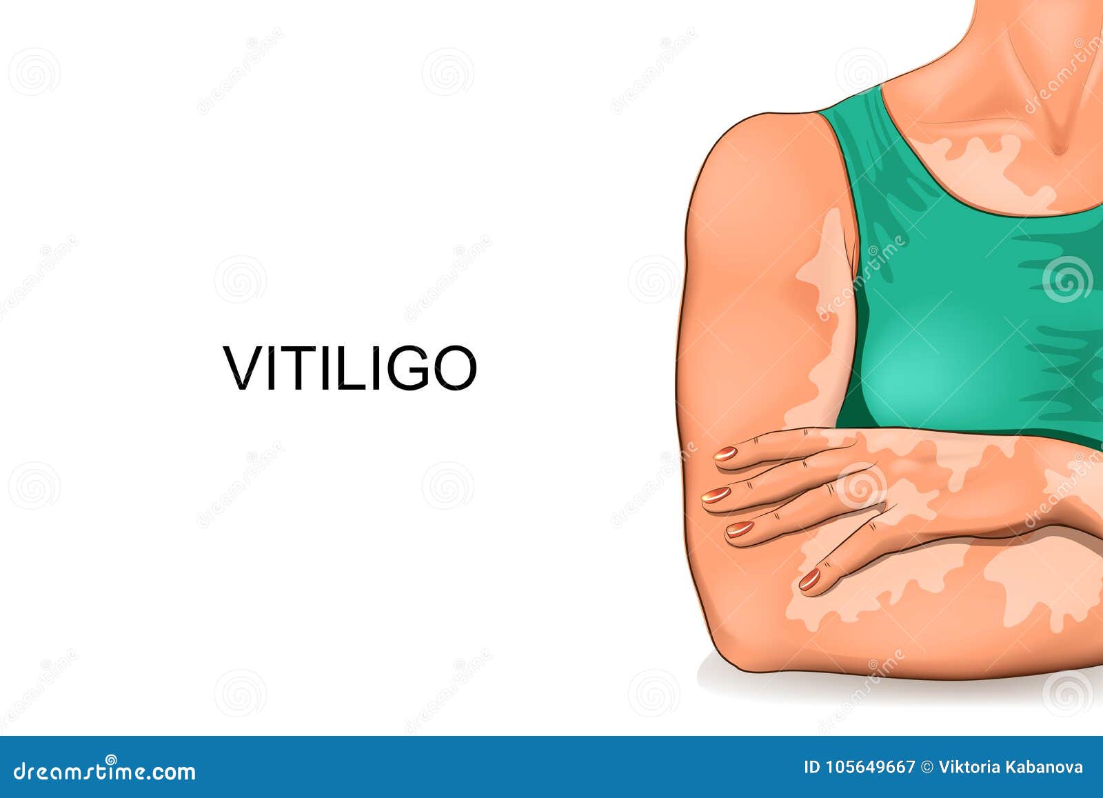 Vitiligo Cartoons, Illustrations & Vector Stock Images - 1716 Pictures ...