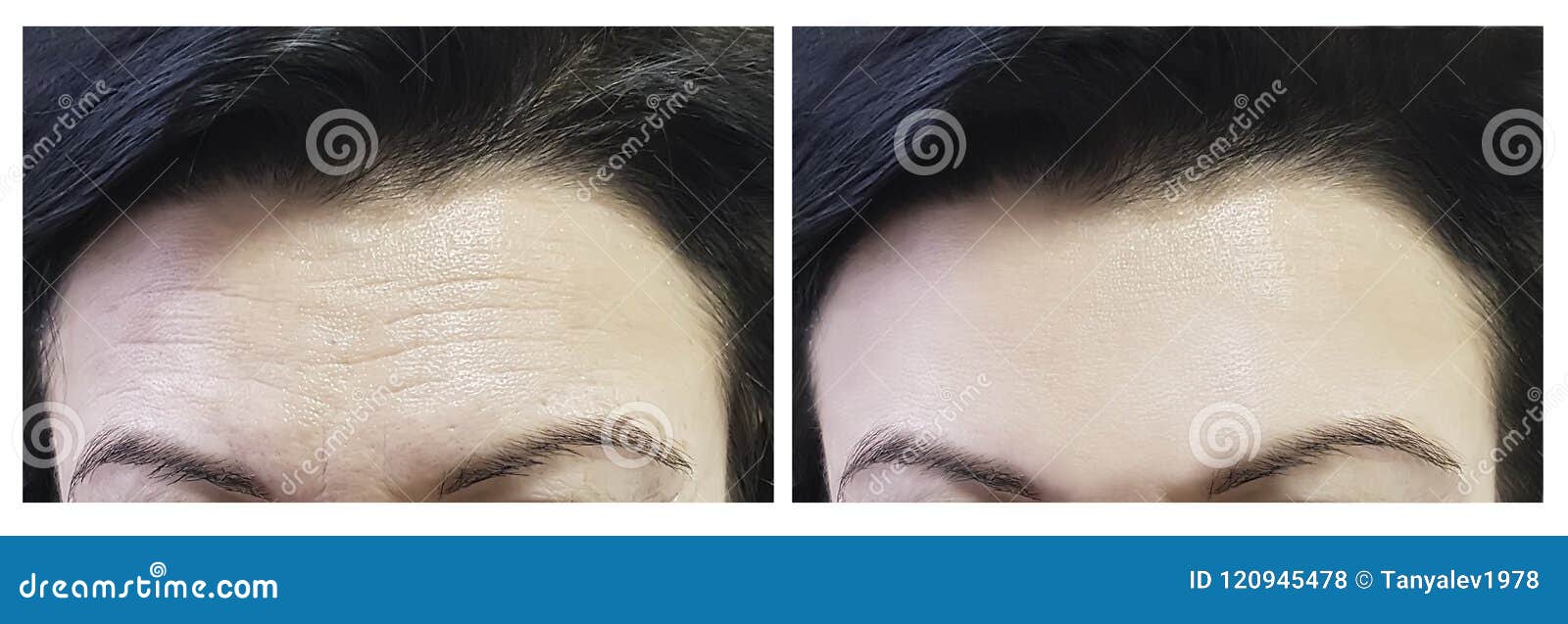 Woman`s Forehead before and after Procedures Stock Photo - Image of ...