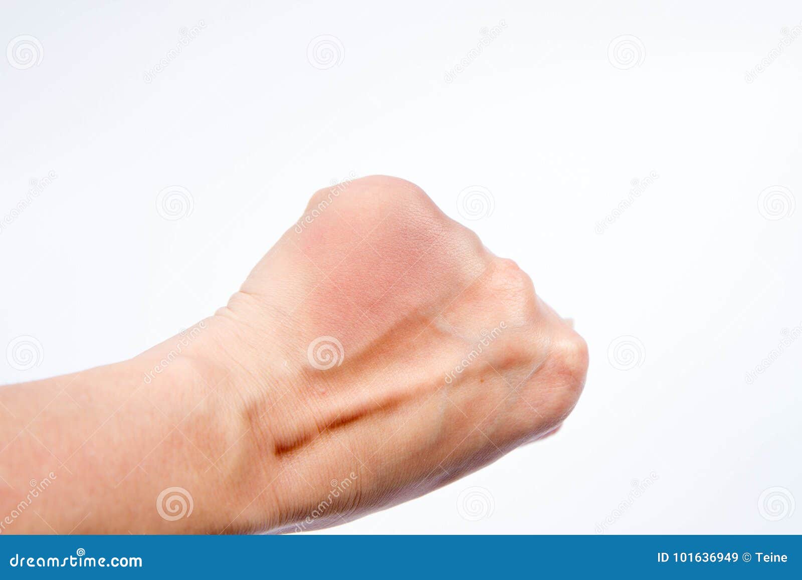 Bruised hand stock image. Image of womans, bruised, bruise - 101636949