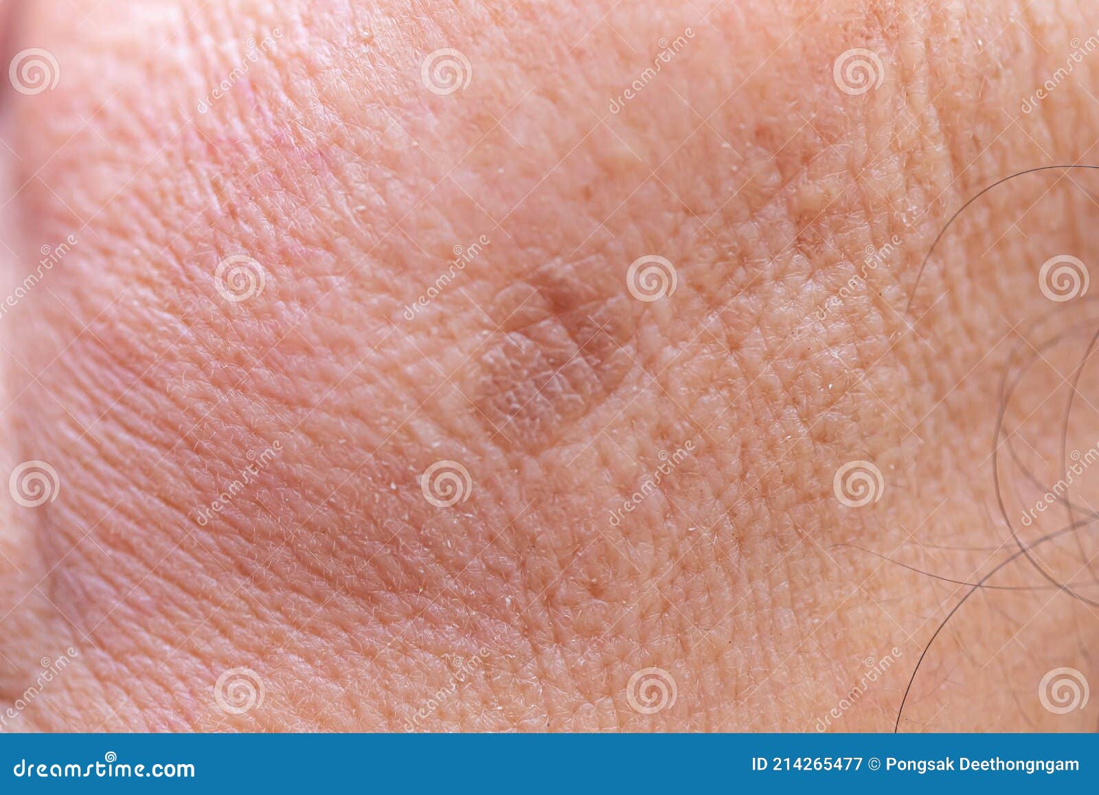 Dark spots on the face stock image. Image of human, adult - 214265477