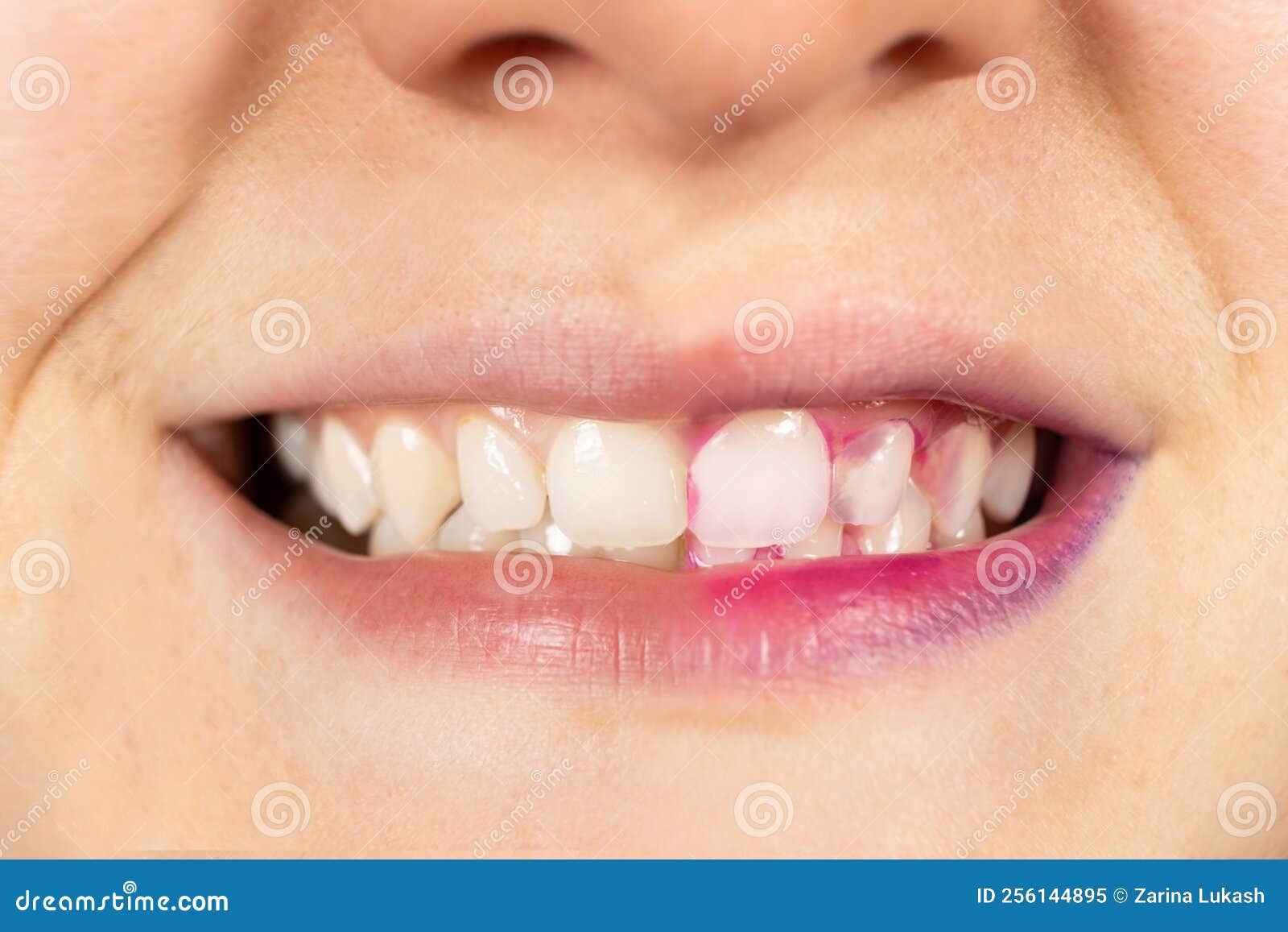 A Woman S Teeth before and after Using Indicator Pills To Determine ...
