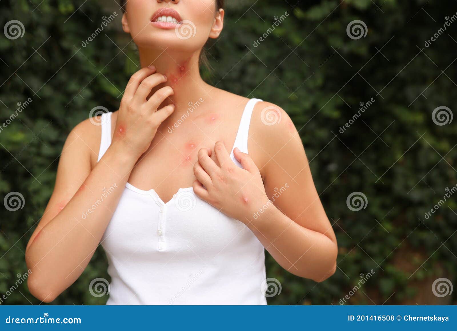 Woman Scratching Neck with Insect Bites in Park, Closeup Stock Photo ...