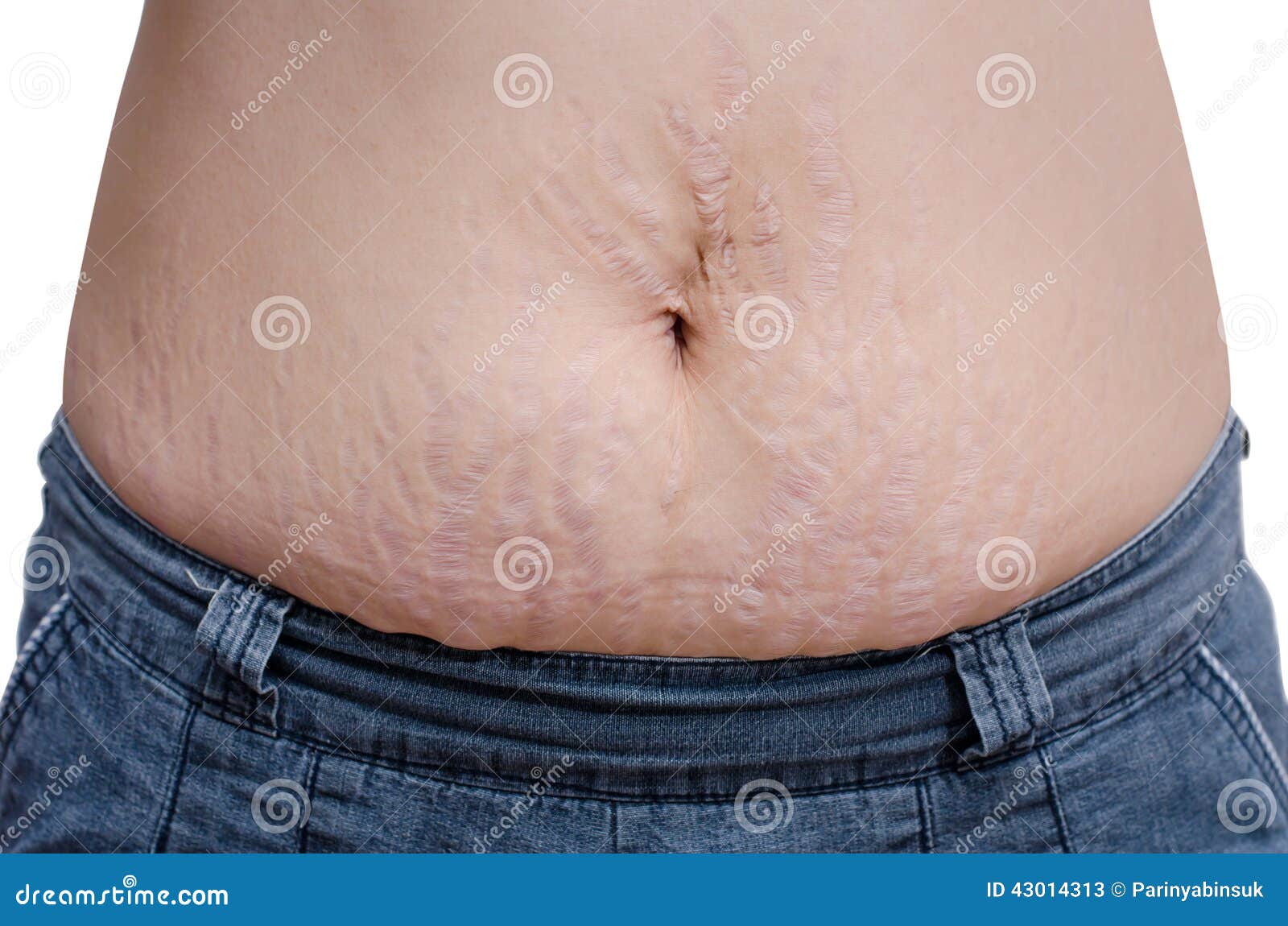Woman Showing Her Stretch Marks Stock Image - Image of post, asian ...