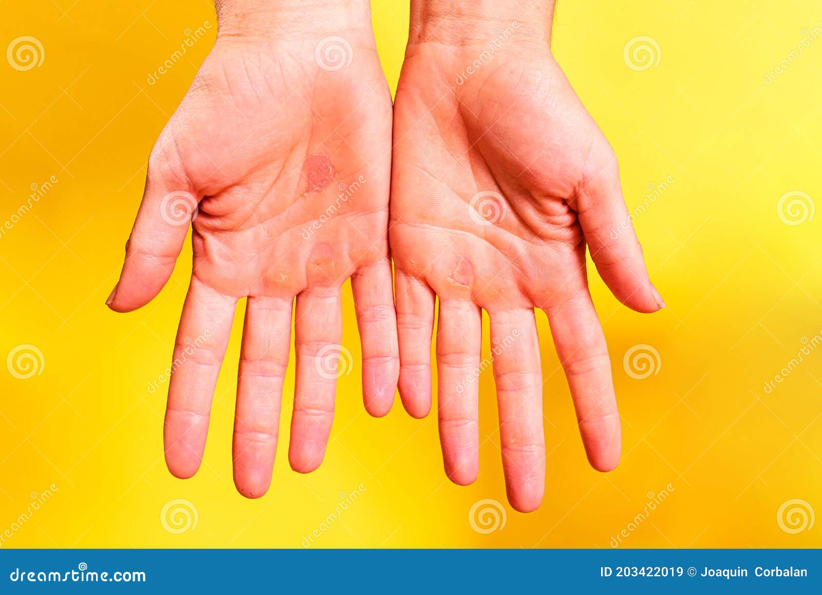 Woman Shows the Palms of Her Hands with Calluses from Hard Work, on ...