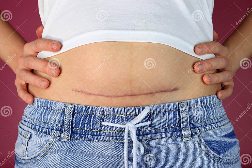 Woman Shows The Scar Of Caesarean Section On Stomach Stock Image