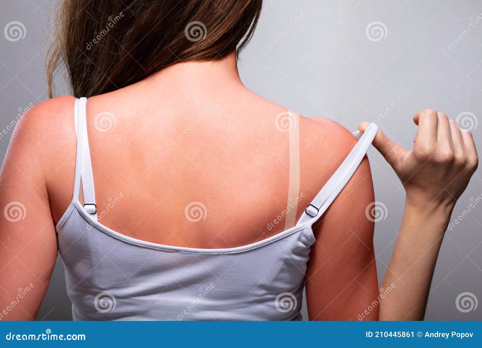 Woman Leg With Red Sunburn Skin On Seaside Background Sunburned Skin