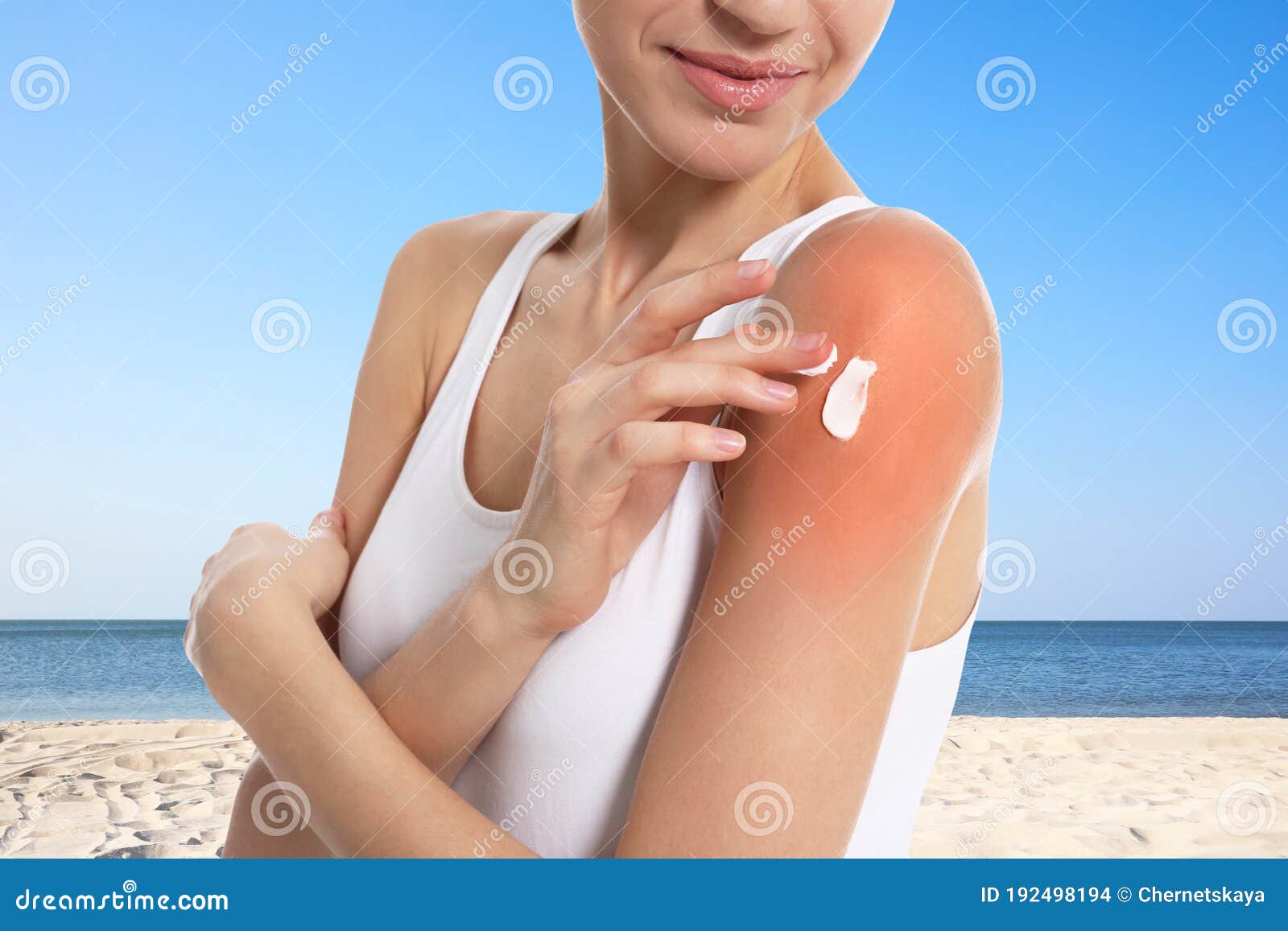 Woman With Sunburn On Beach Skin Protection From Sun In Summer Stock