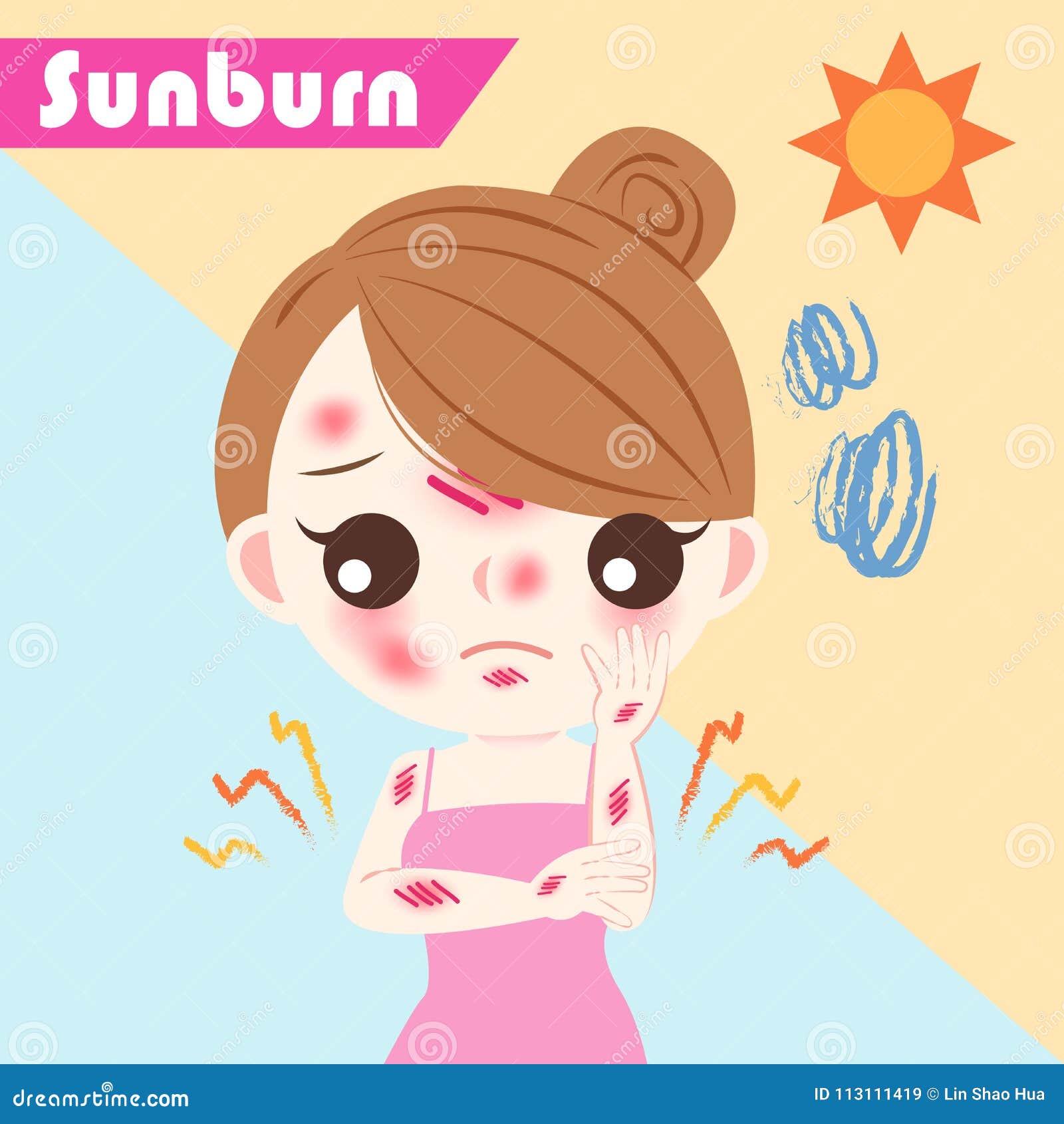 Woman with sunburn problem stock illustration. Illustration of ...