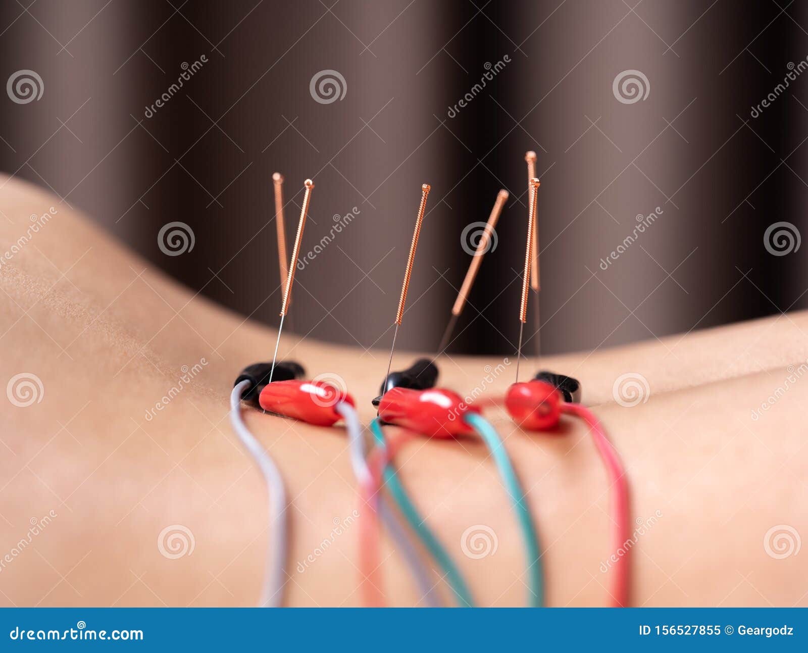 Woman Undergoing Acupuncture Treatment with Electrical Stimulator on ...