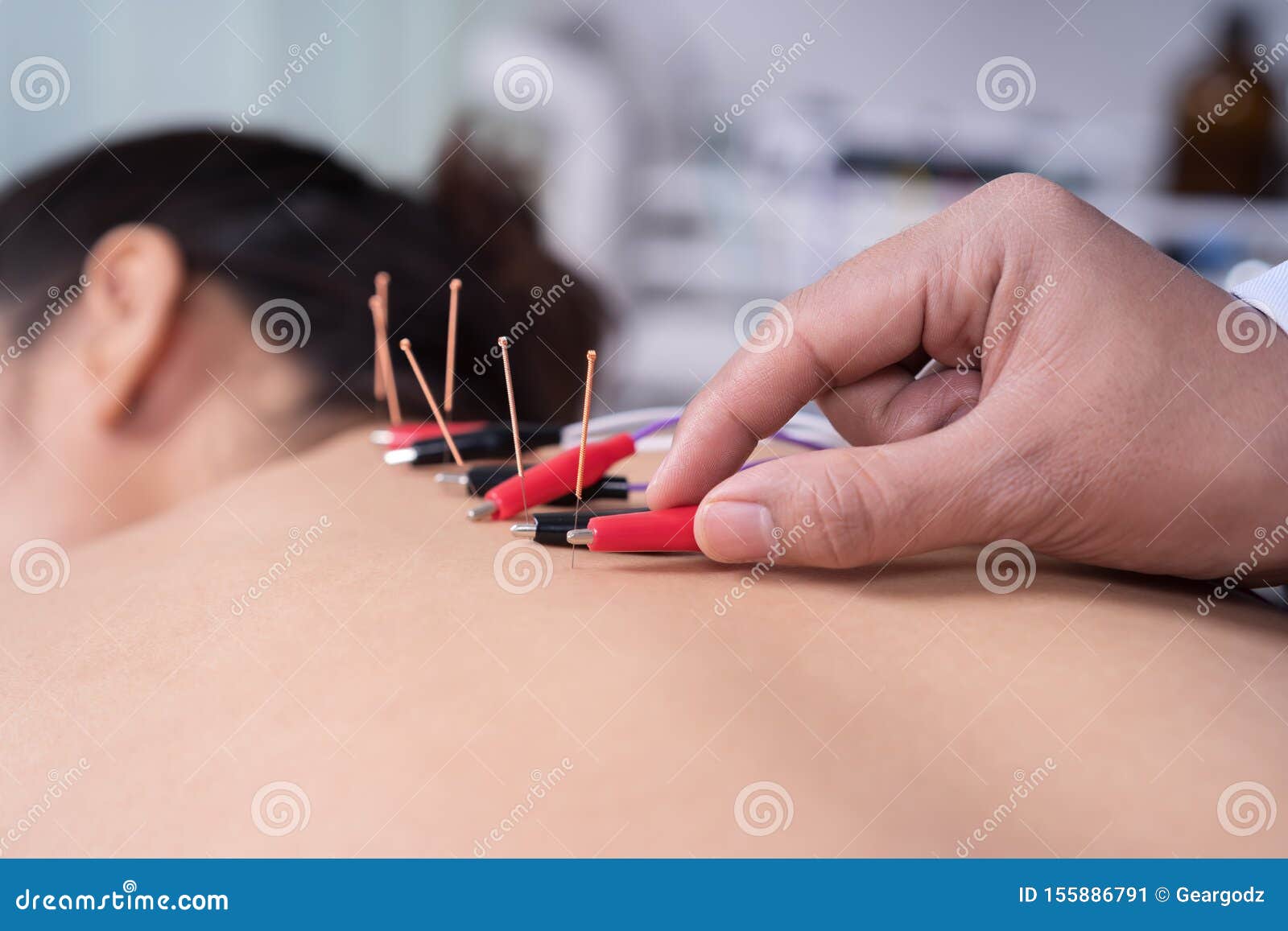 Woman Undergoing Acupuncture Treatment with Electrical Stimulator on ...