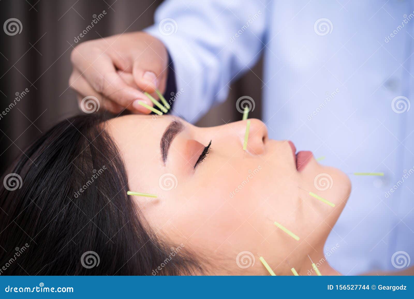 Woman Undergoing Acupuncture Treatment on Face Stock Photo - Image of ...