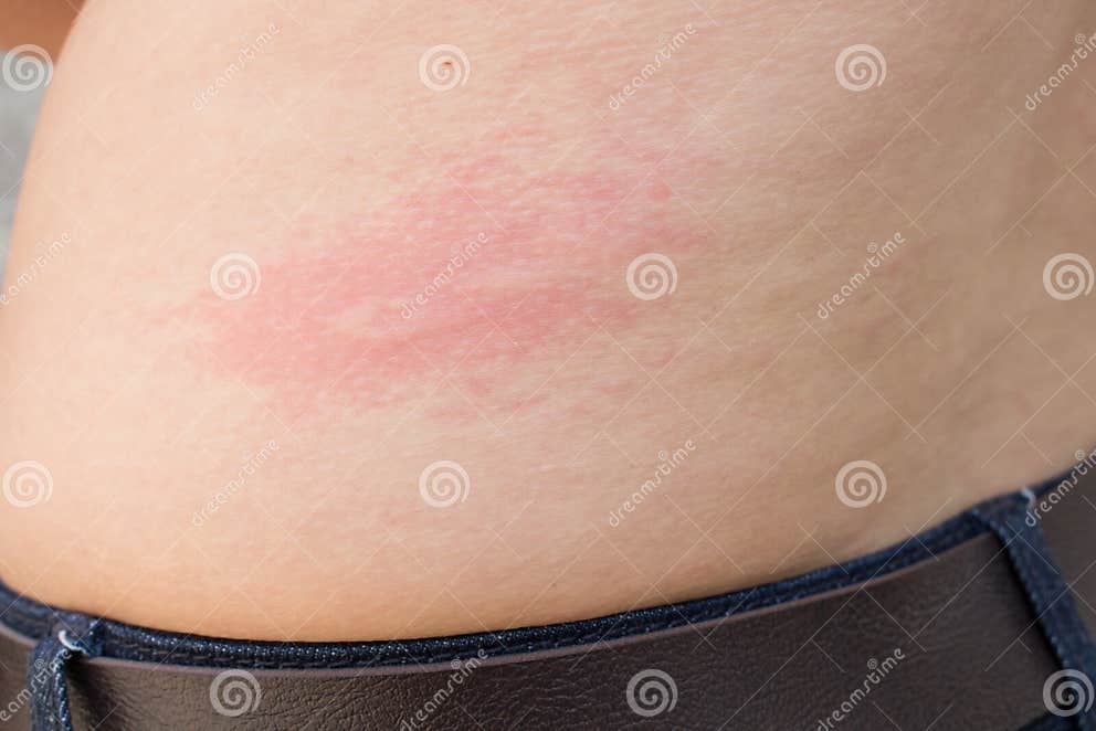 A Woman is Urticaria on Back Stock Photo - Image of lesions ...