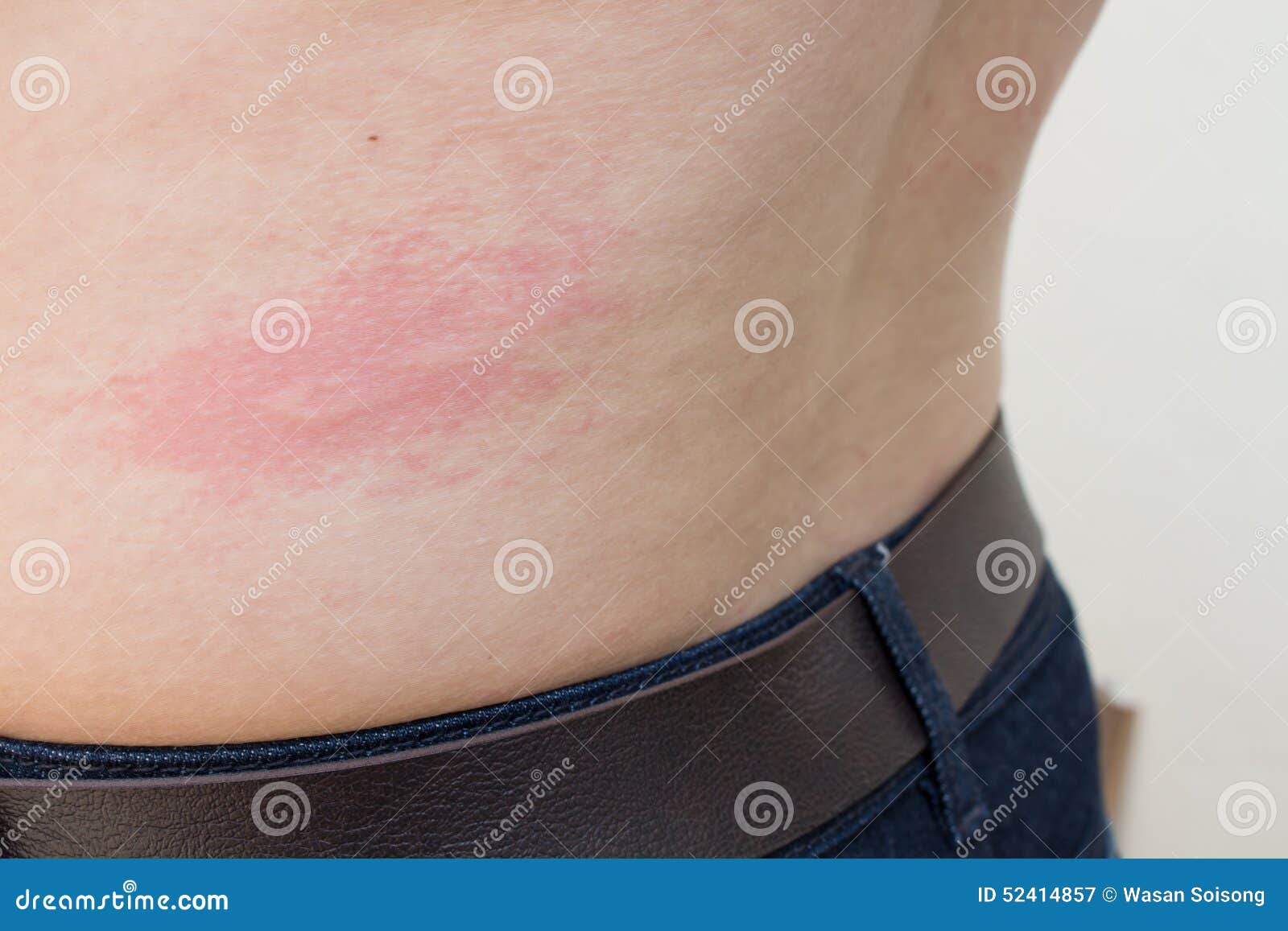 Dermatographic Urticaria On Back