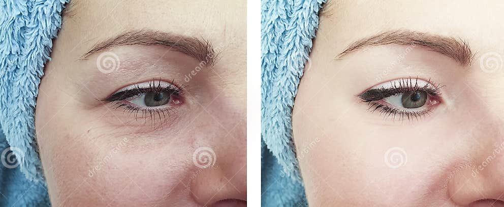 Woman Wrinkles Face Mature Difference Tension Before And After Removal