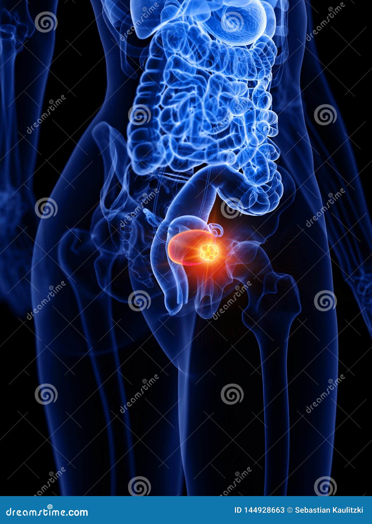 A womans bladder tumor stock illustration. Illustration of cancerous ...