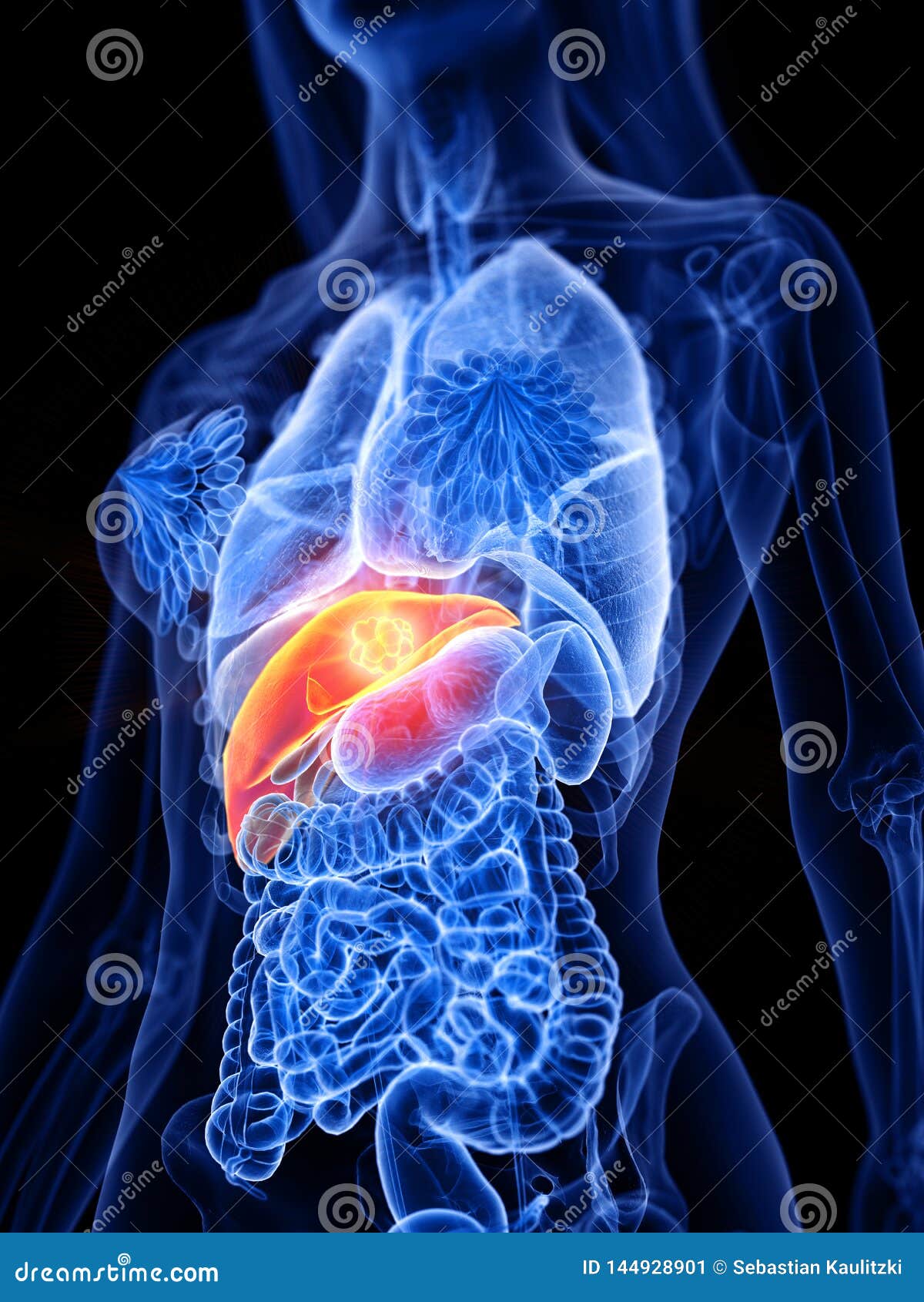 A womans liver tumor stock illustration. Illustration of digestion ...