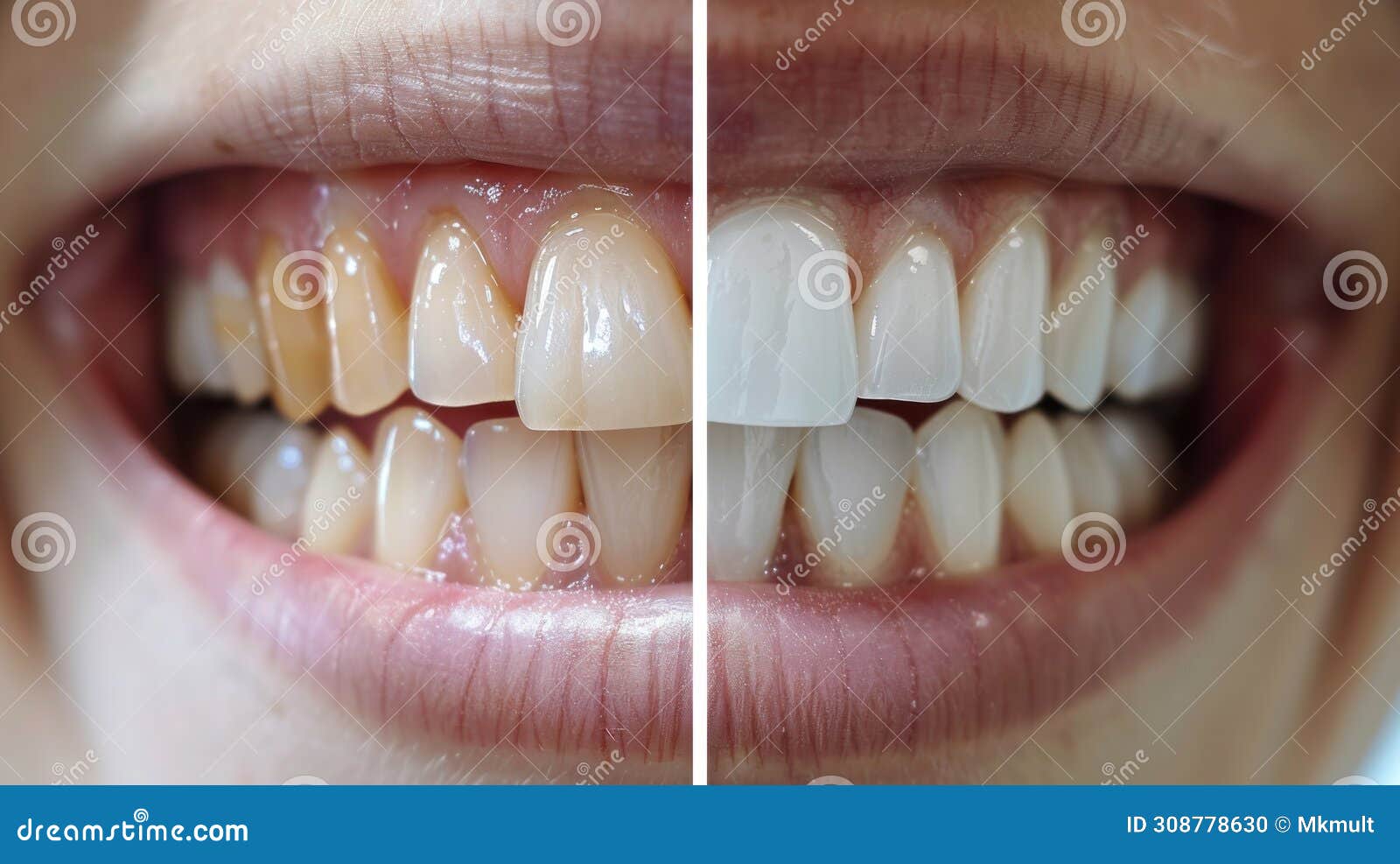 Womans Teeth Transformation: before and after Whitening Stock Photo ...