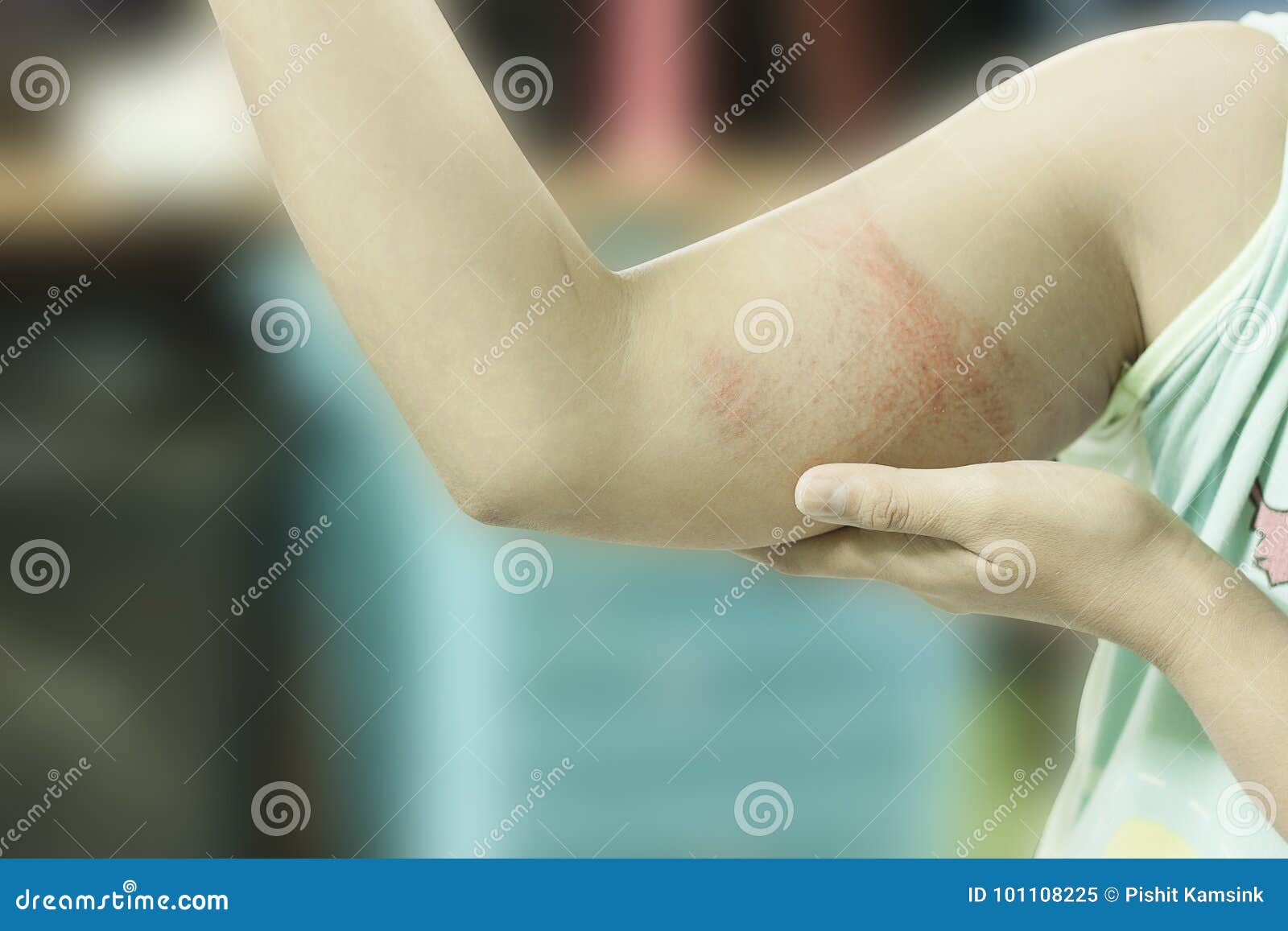 Women Have Bruises in the Arm Stock Image - Image of health, applying ...