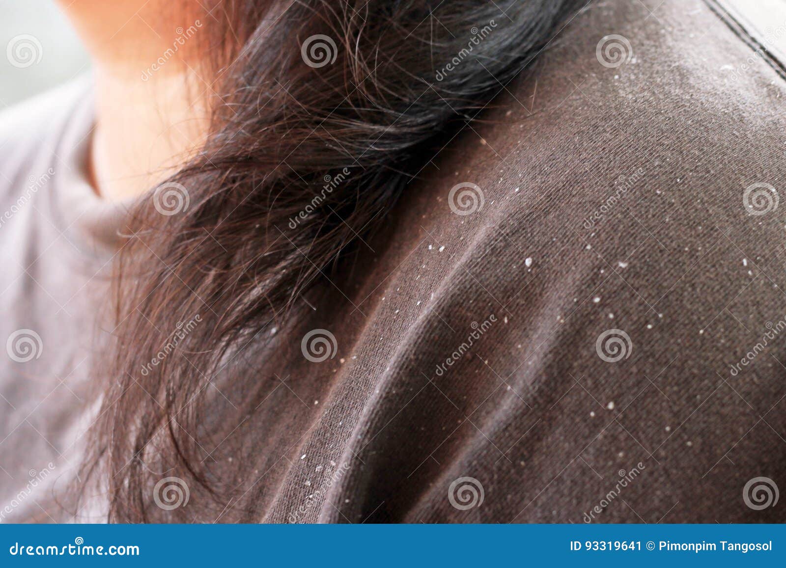 Women having dandruff stock image. Image of person, psoriasis - 93319641