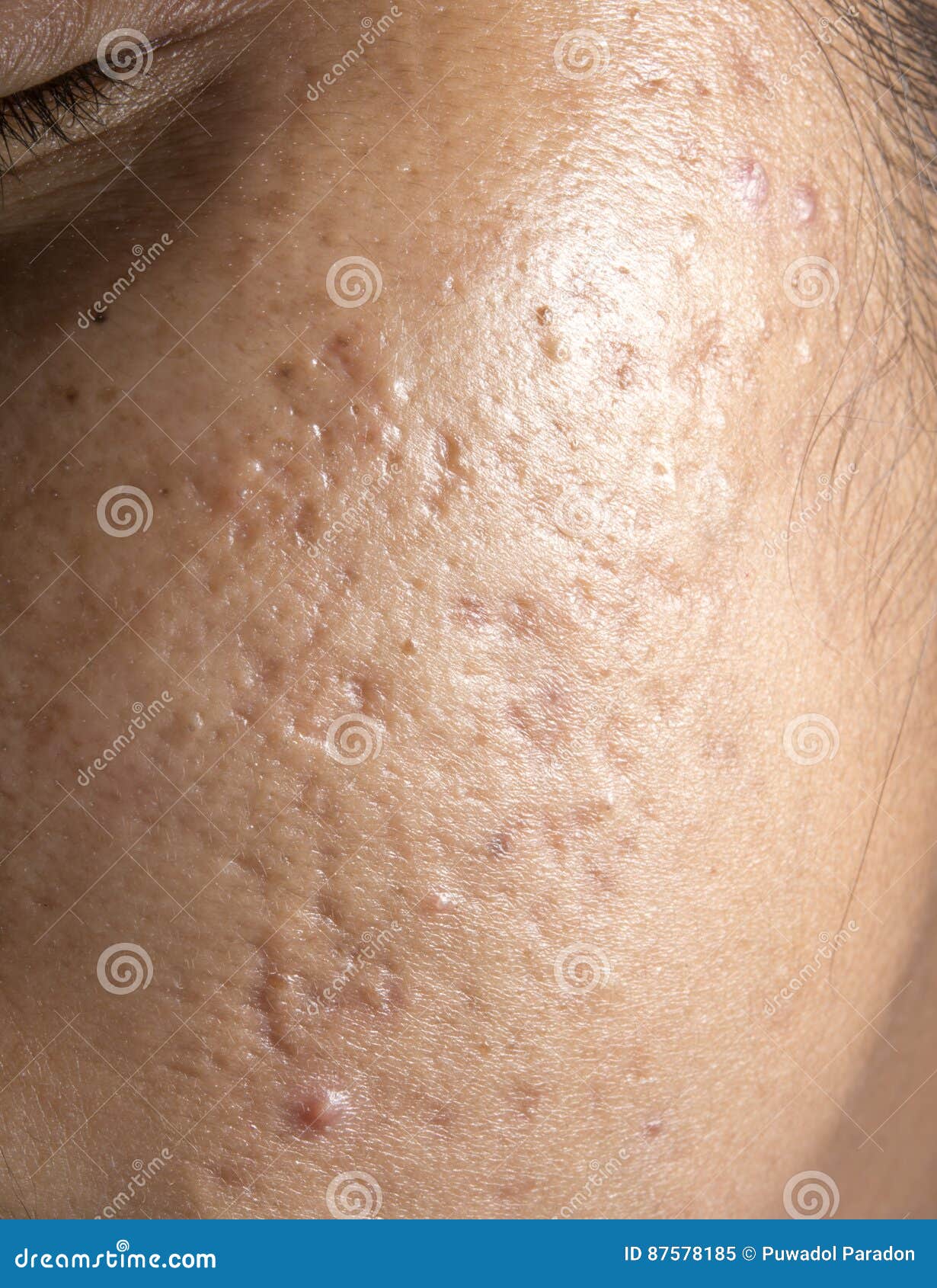 Women with Problematic Skin and Acne Scars Stock Image - Image of face ...