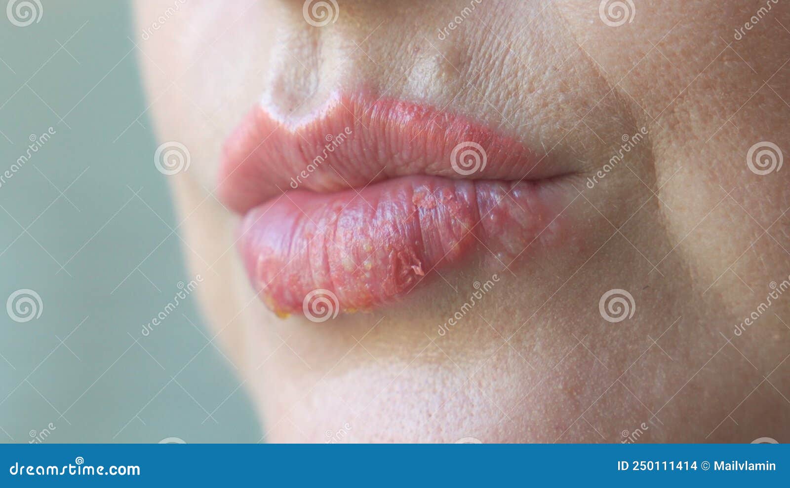 Women`s Lips with Herpes Pimples Stock Photo - Image of condition, pain ...
