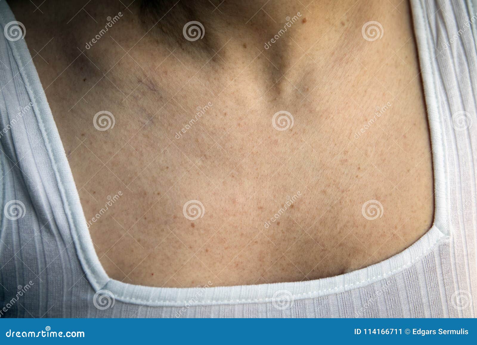 Women with Skin Pigmentation and Lot of Birthmarks Stock Image - Image ...