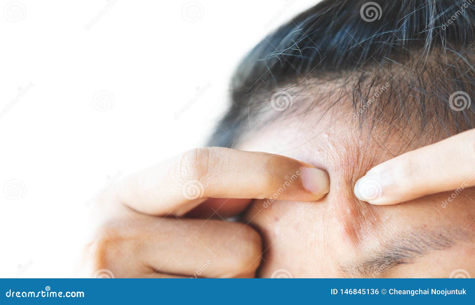 Women are Squeezing the Forehead Acne Stock Photo - Image of squeezing ...