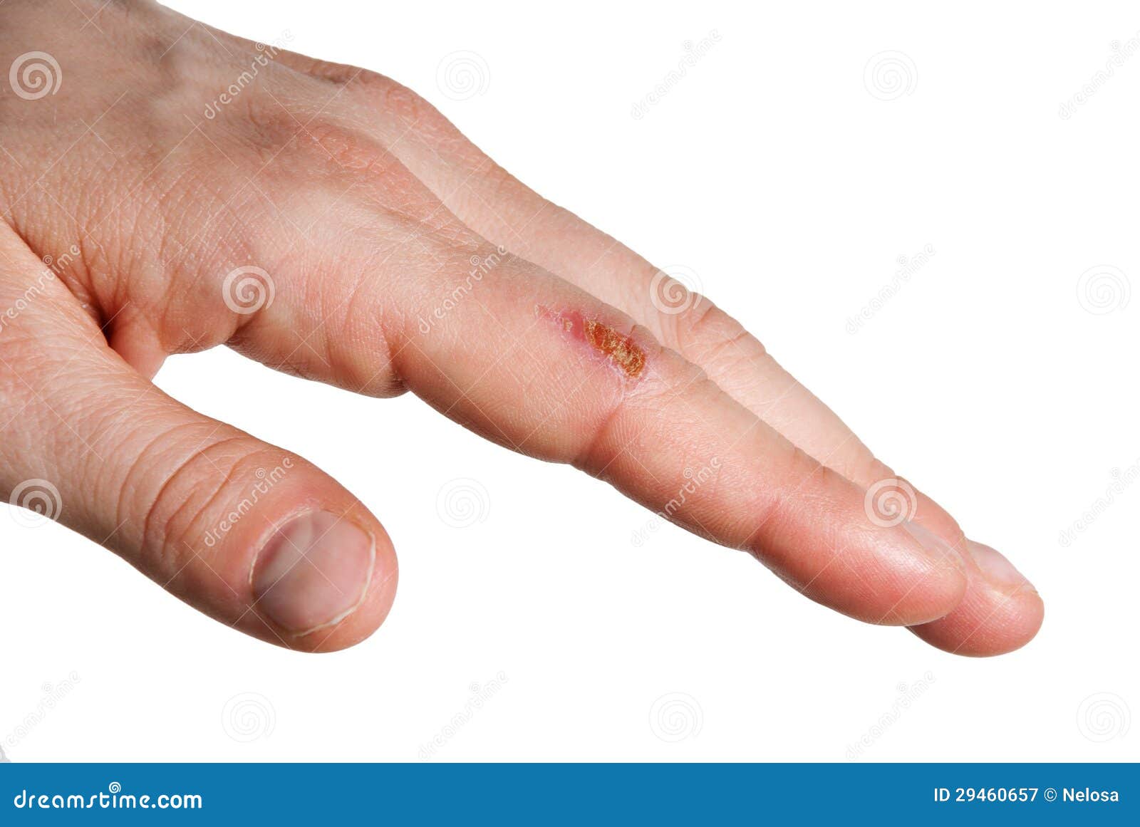 Wond bij een vinger stock afbeelding. Image of aanspreken - 29460657