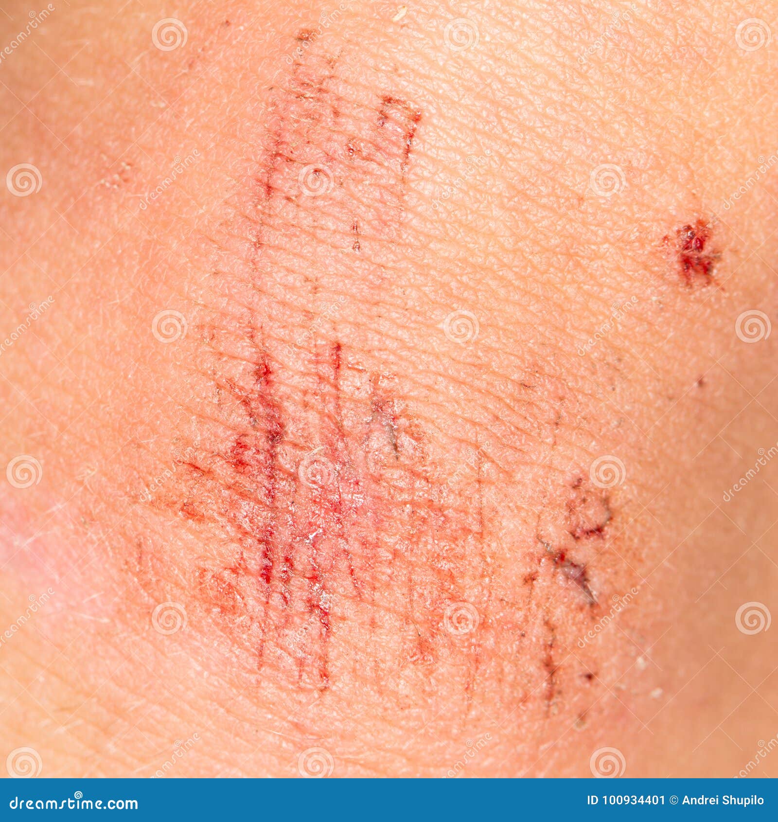 Wond op de huid Close-up stock afbeelding. Image of ongeval - 100934401