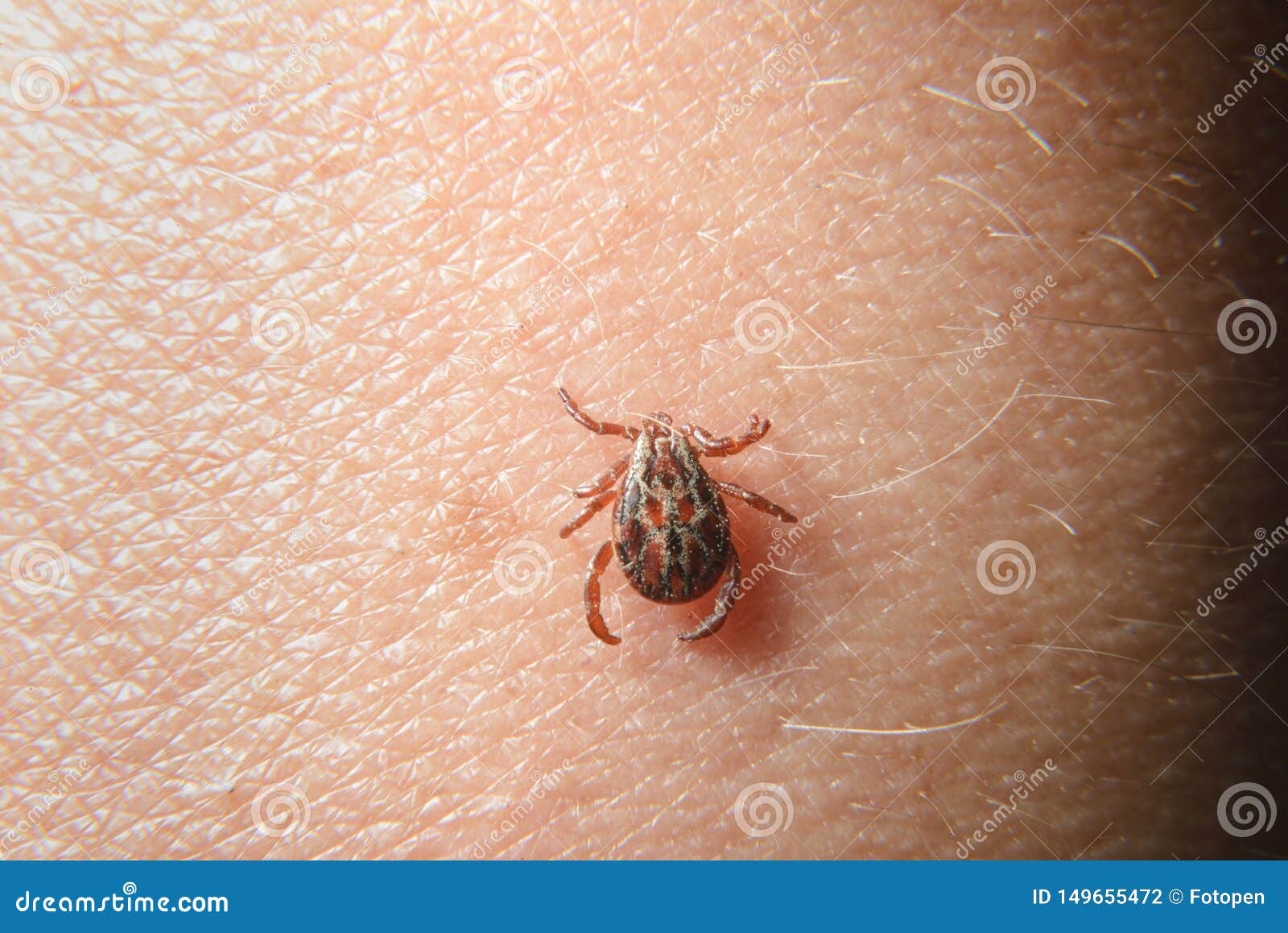 Forest Mite on the Skin. Wood Tick Stock Photo - Image of macro, human ...