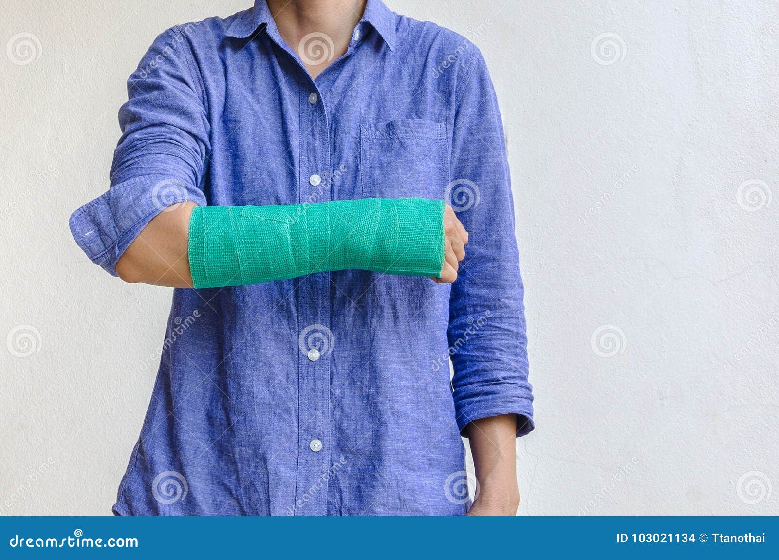 Worker Woman Accident on Arm with Green Cast Stock Photo - Image of ...