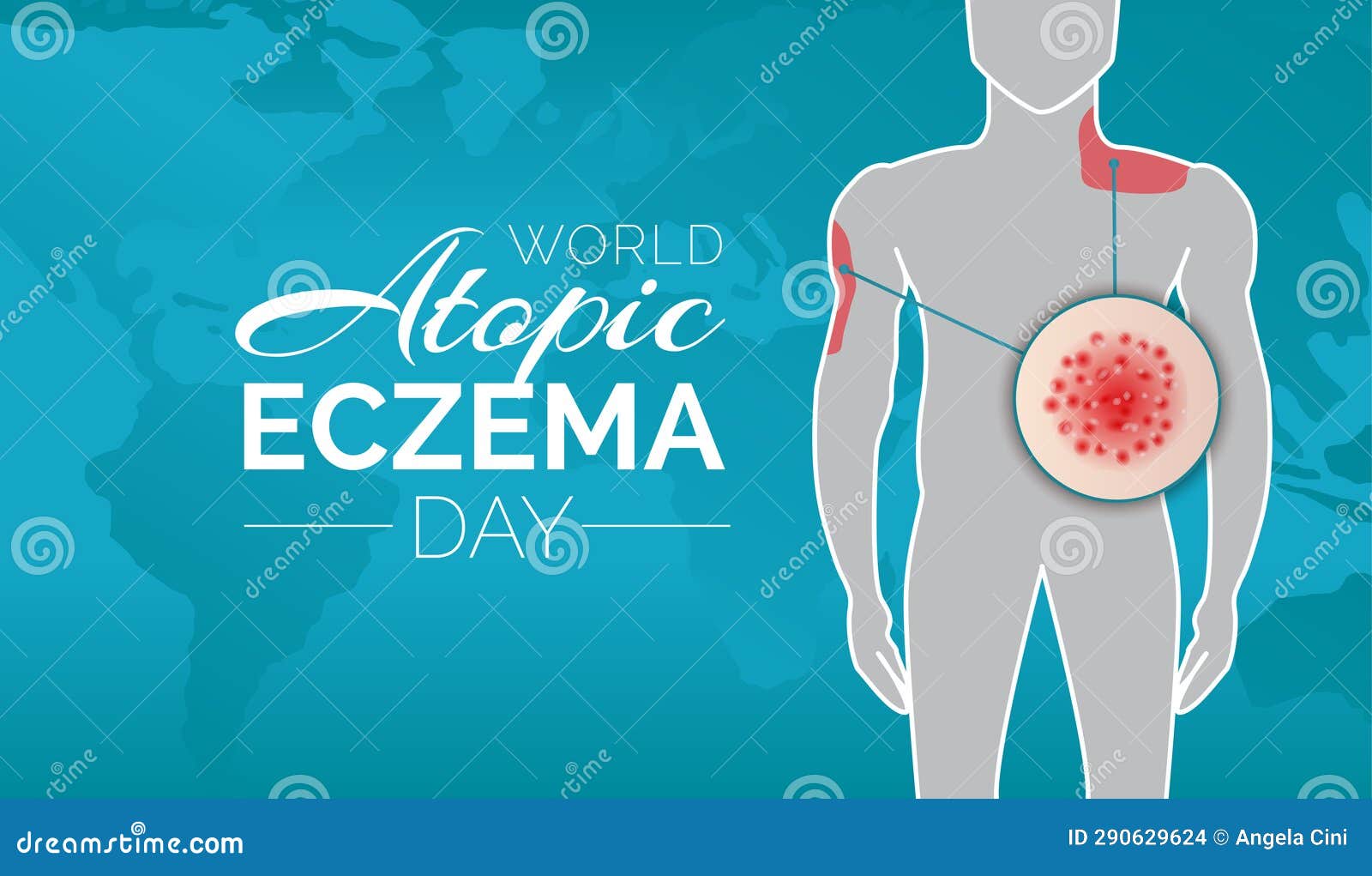 World Atopic Eczema Day Background Illustration Design With People ...