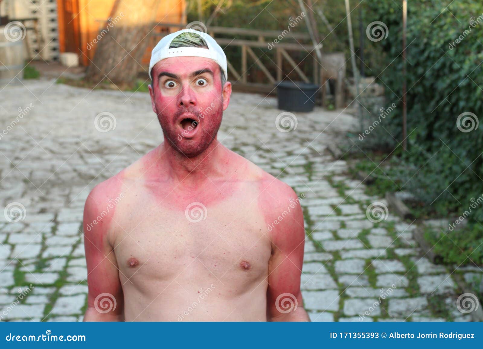 Worried Sunburned Man With Skin Irritation Stock Image Cartoondealer