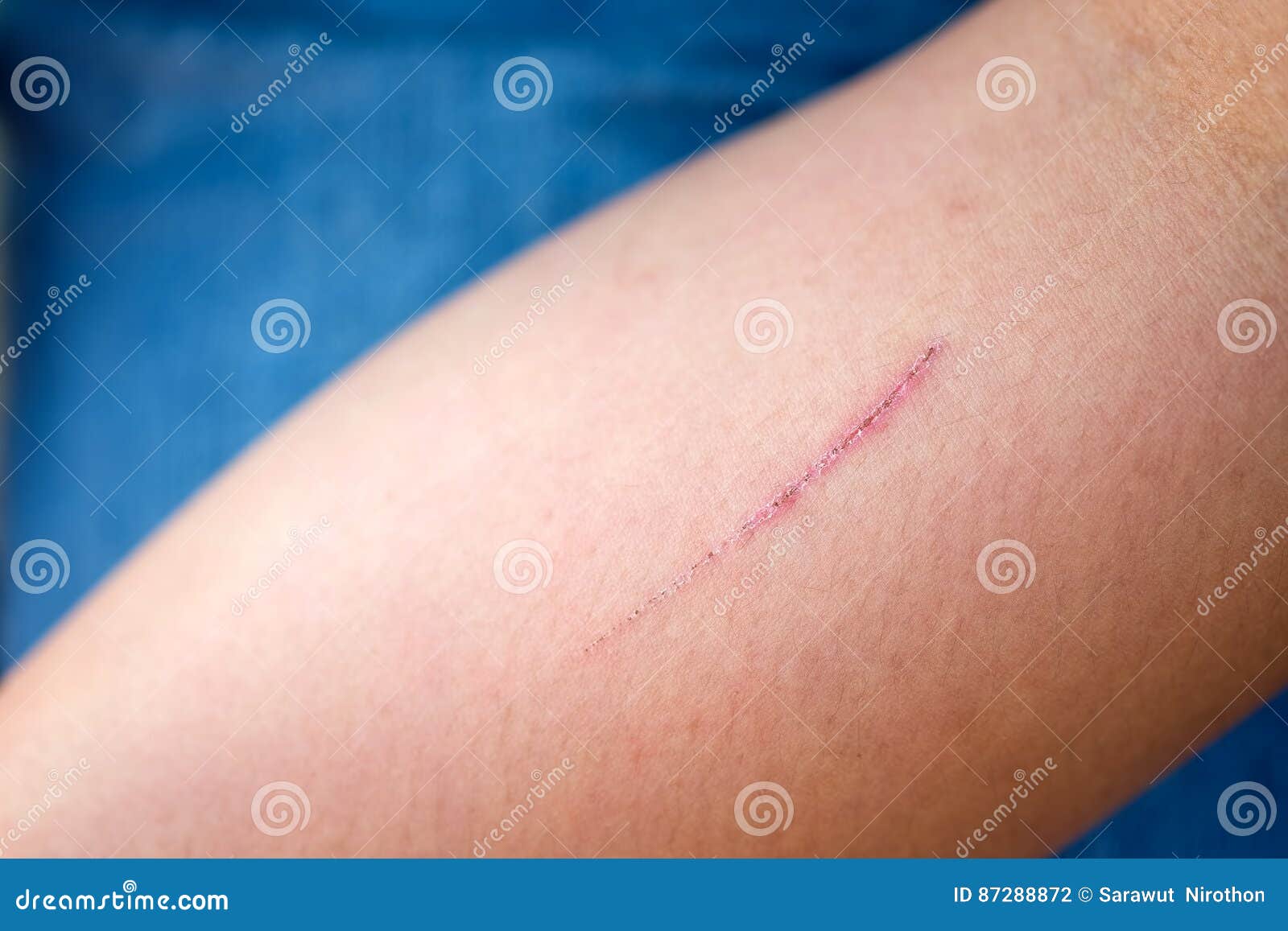 Wound in the arm. stock photo. Image of skin, wounds - 87288872