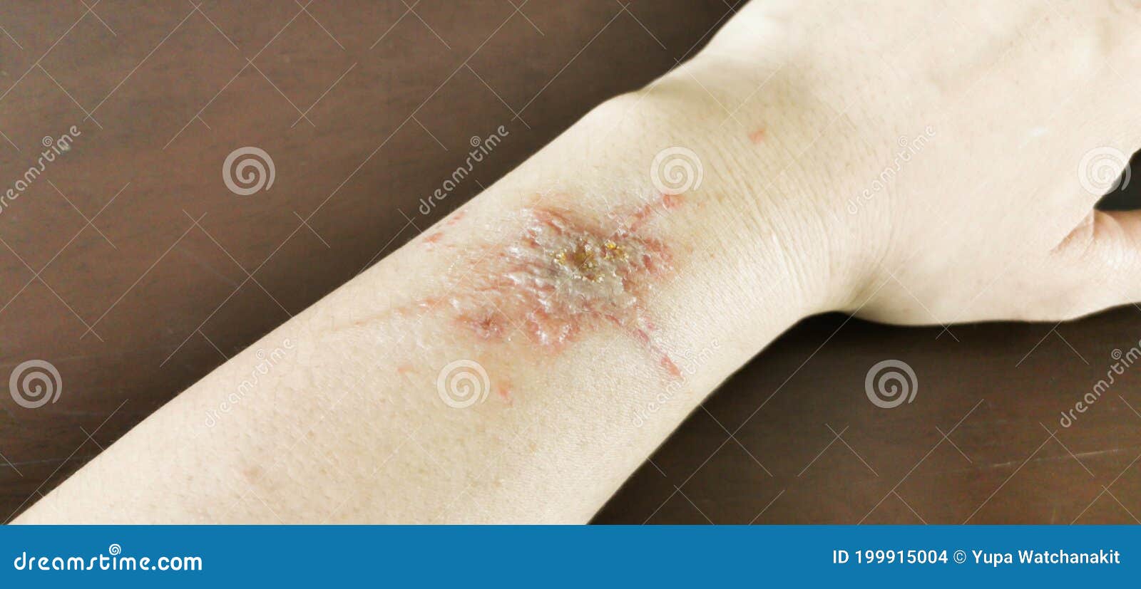 Wound on arm from Insect stock photo. Image of medical - 199915004