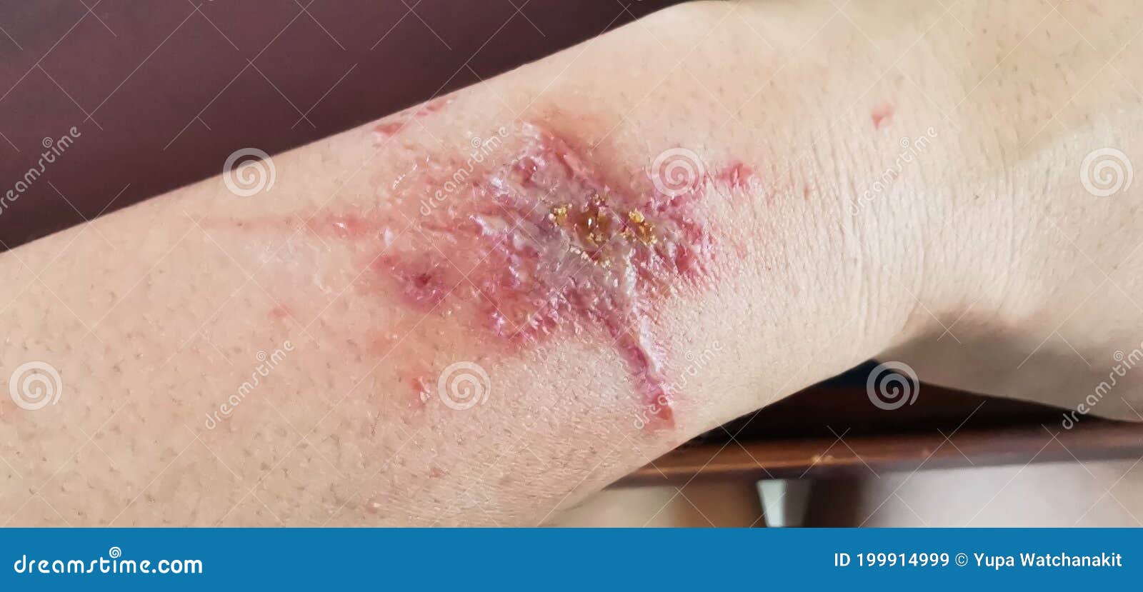Wound on arm from Insect stock image. Image of allergy - 199914999