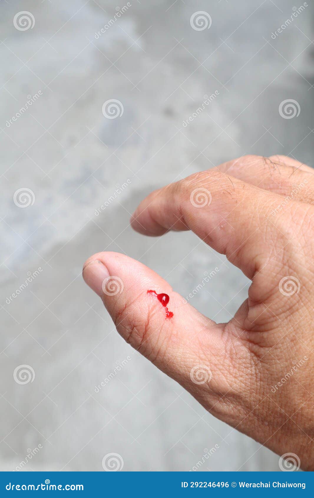 Wound on the Back of His Right Finger Was Bleeding. Stock Photo - Image ...