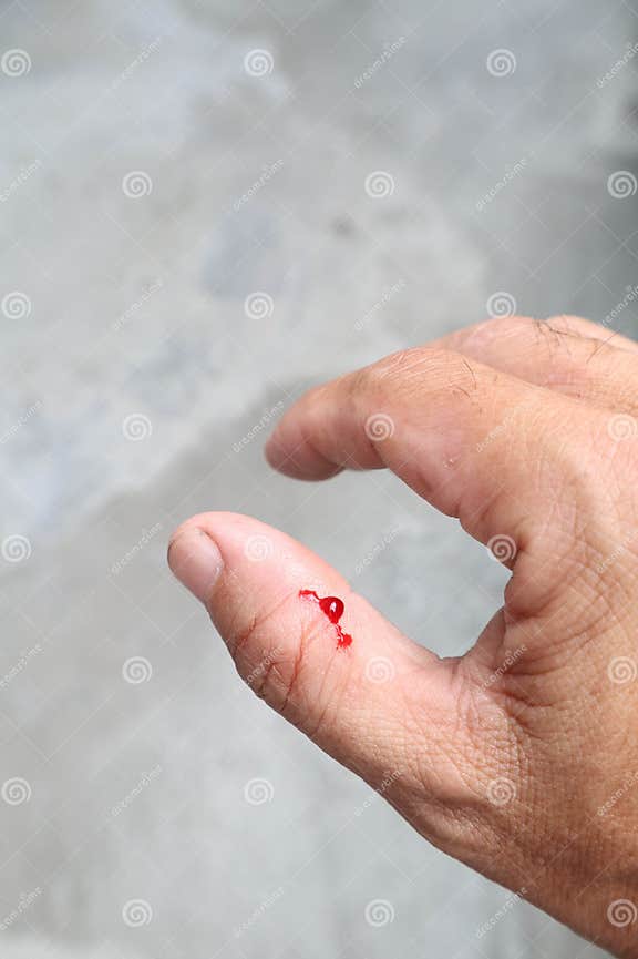Wound on the Back of His Right Finger Was Bleeding. Stock Photo - Image ...