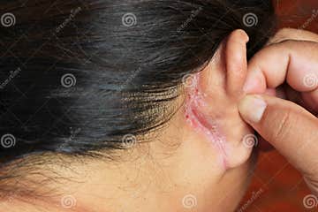 Wound behind ear stock image. Image of deaf, tinnitus - 93319467