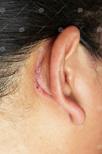 Wound behind ear stock image. Image of tinnitus, medicine - 93319595