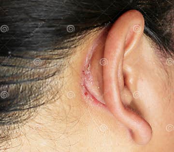 Wound behind ear stock image. Image of blood, help, wound - 93319821