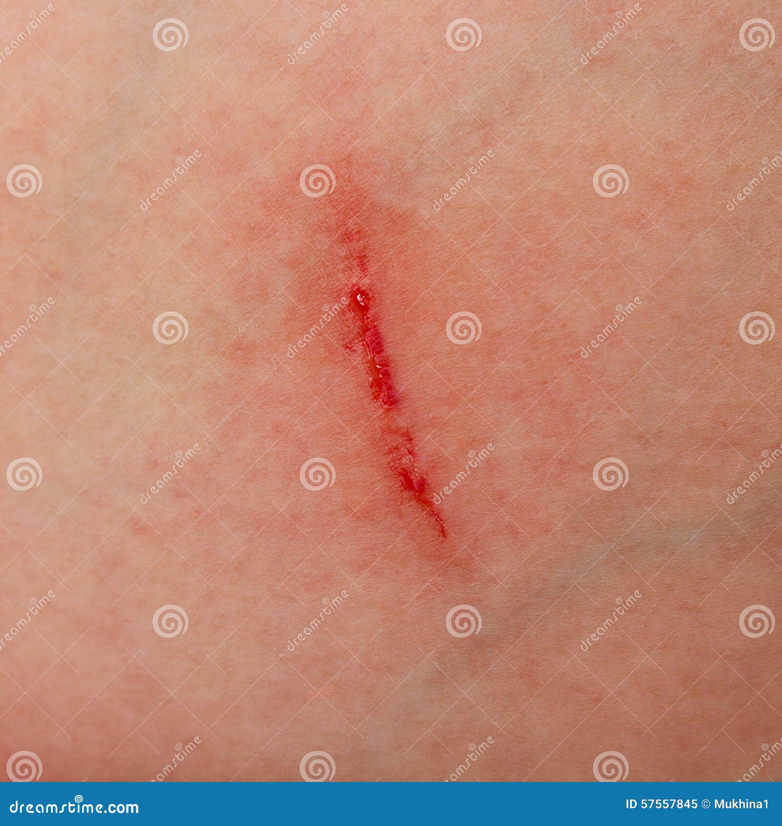 Wound with blood on skin stock image. Image of scratch - 57557845