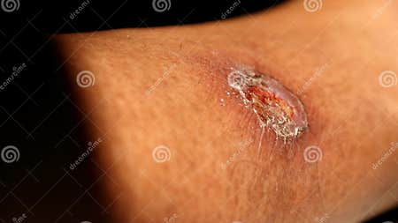 Wound caused by scratching stock photo. Image of dermatology - 235244976
