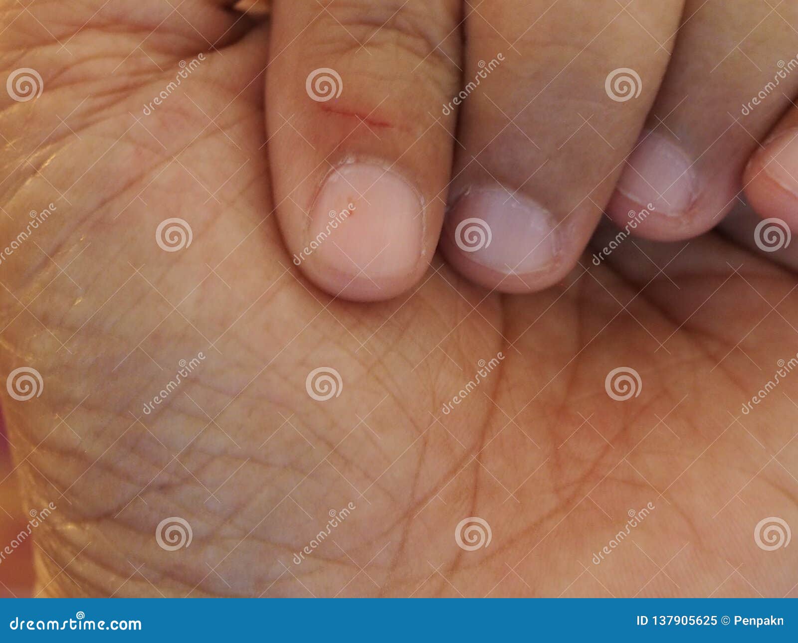The Wound That Is Caused By A Sharp Cut On The Index Finger Is Bleeding ...