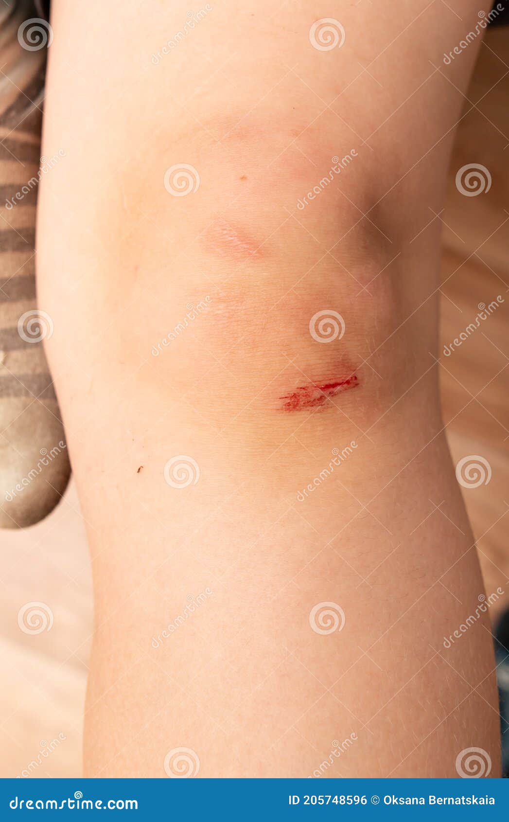 Wound on the child`s knee stock photo. Image of color - 205748596