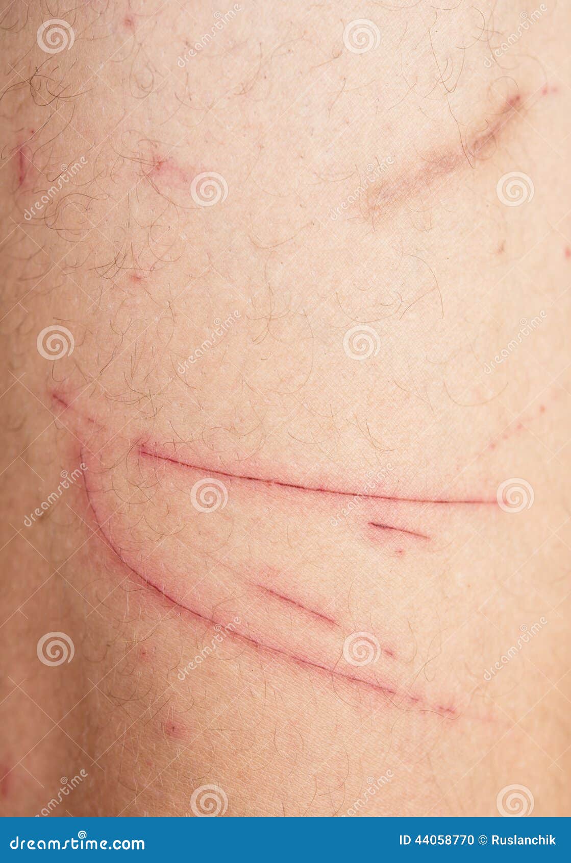 Wound stock photo. Image of dried, membrane, human, injury - 44058770
