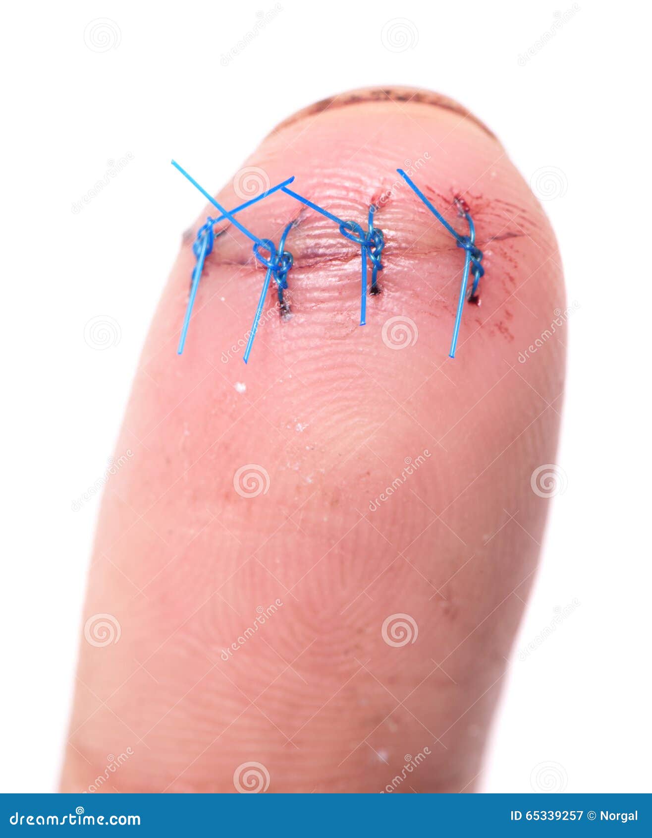 Wound stock image. Image of hospital, incision, flesh - 65339257