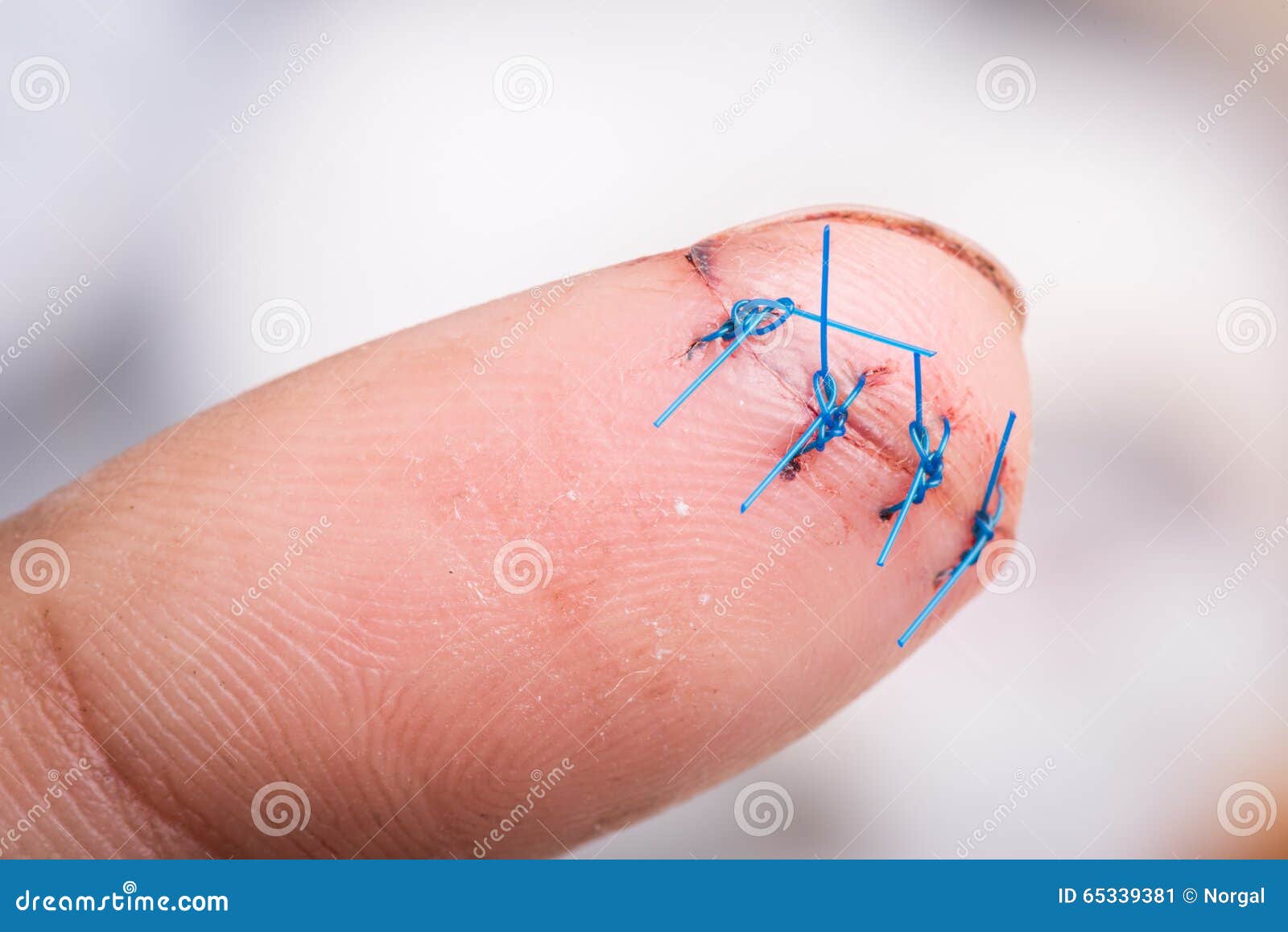Wound stock image. Image of stitch, injure, scar, hurt - 65339381